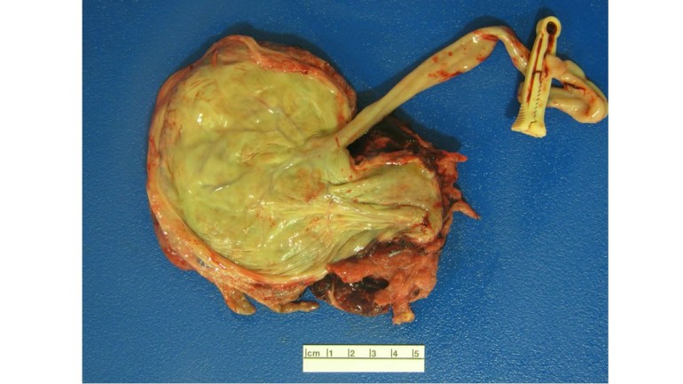 Umbilical Cord – ThinkPlacenta